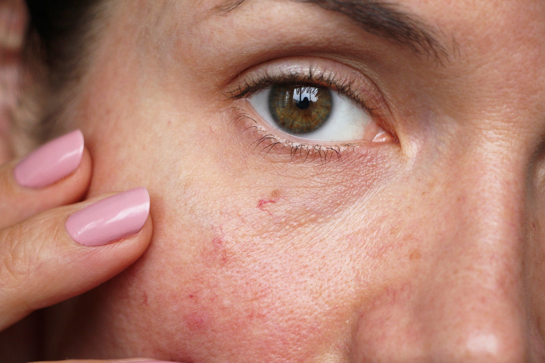 Skin Redness? Here's What Might Be Causing It