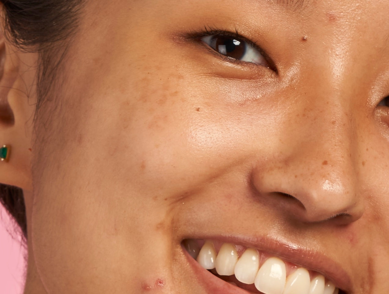 The Ultimate Guide to Every Type of Dark Spot