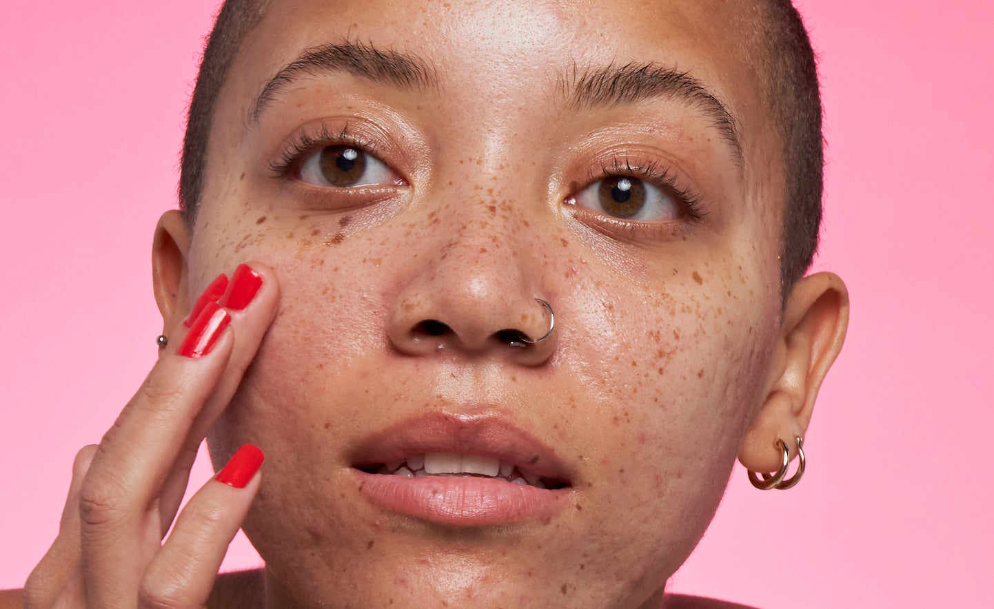 Is It Acne or Is it: Folliculitis, Sebaceous Filament, Rosacea, Kerato